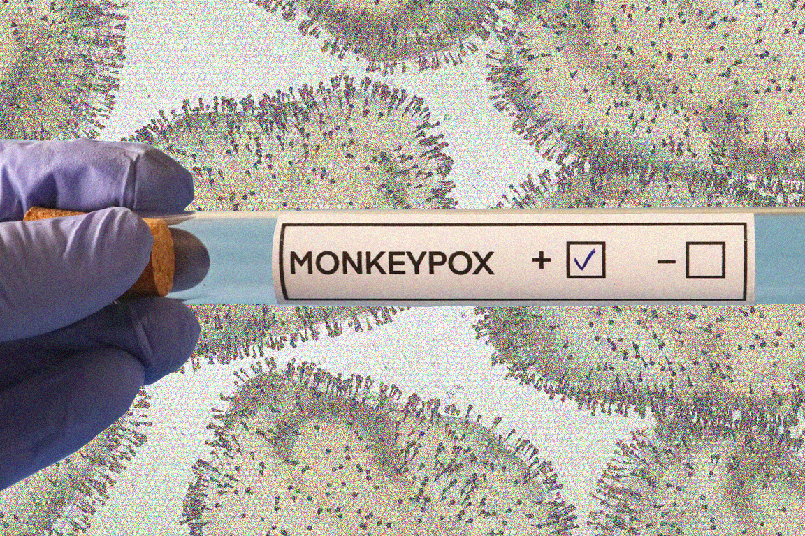 Here’s what we know about Monkeypox – The Connector